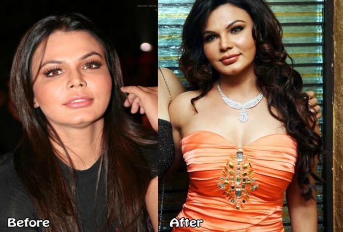 Top 10 Bollywood Plastic Surgeries Disasters Before And After Heart Bows And Makeup